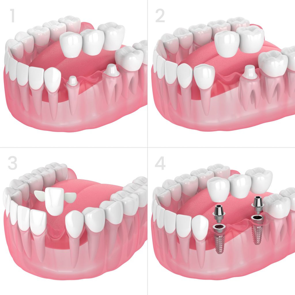 Expertly Crafted Dental Bridges for a Natural Look - Isle of Wight ...