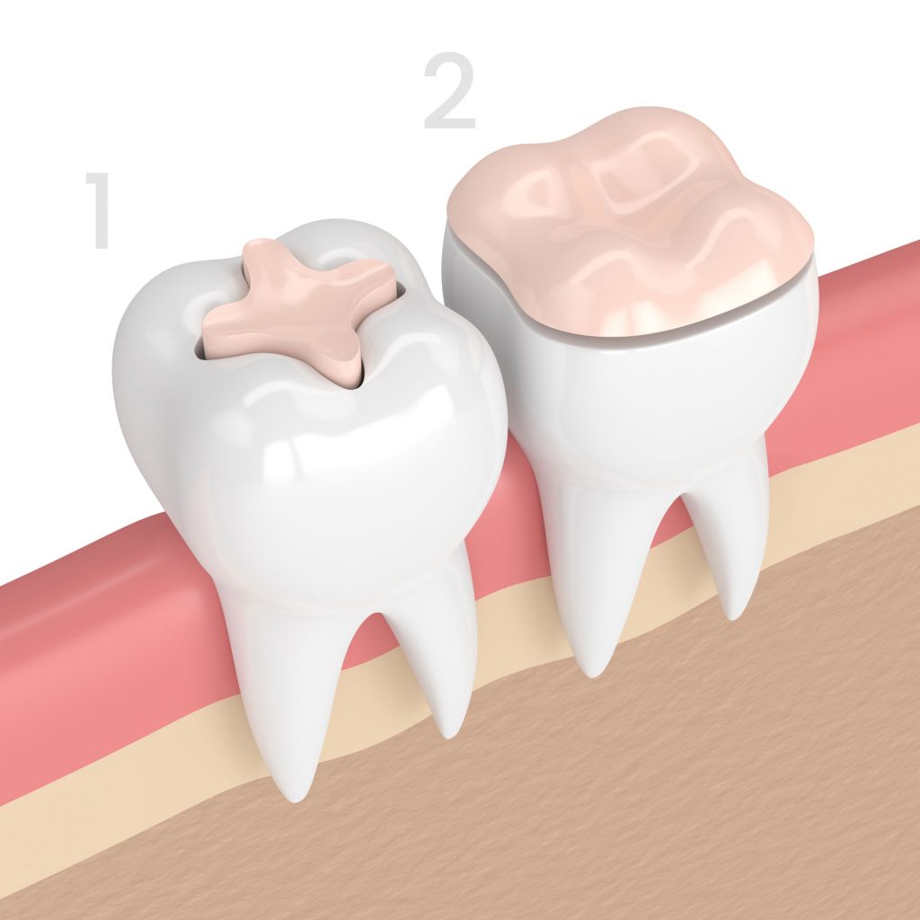 Dental Inlays and Onlays - Isle of Wight Dental